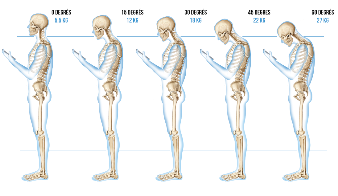 Stop aux douleurs de nuque et fourmillements dans les mains - CTS ...