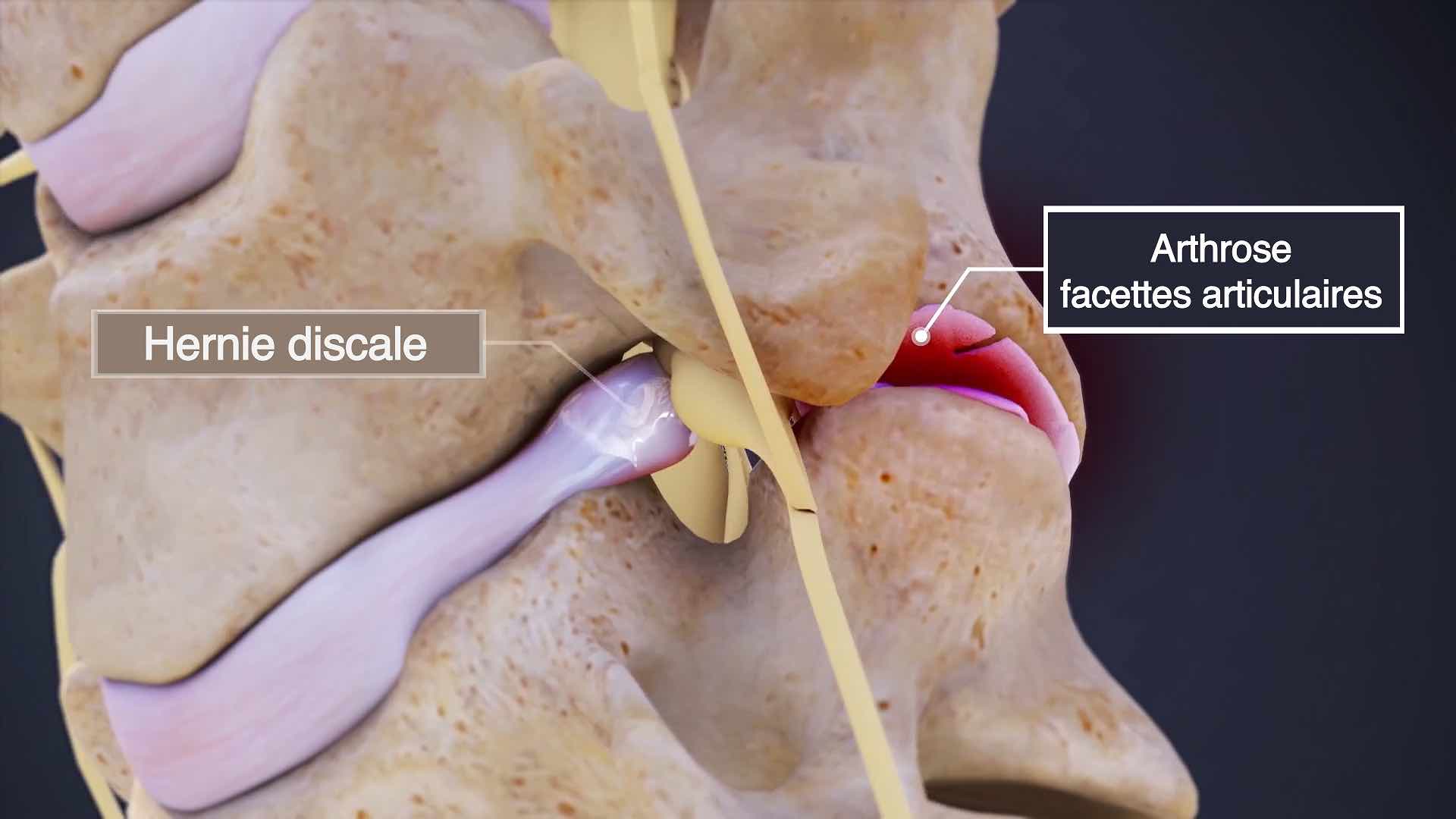 Stop aux douleurs de nuque et fourmillements dans les mains - CTS ...